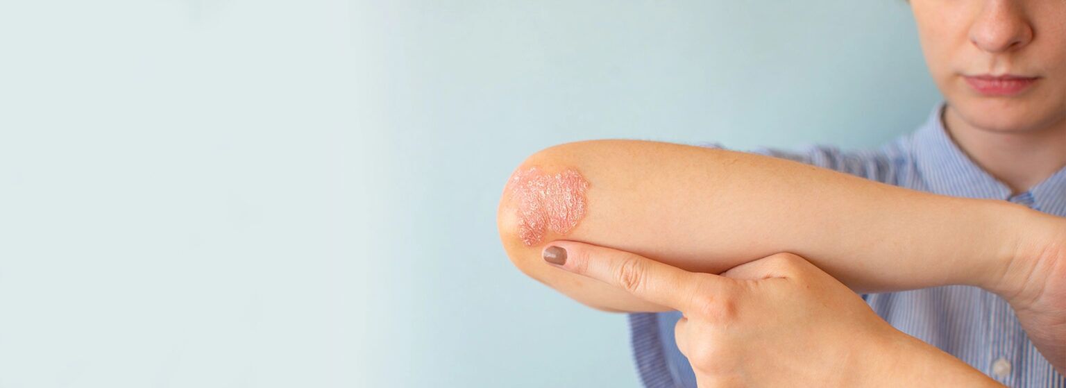 What Is Ringworm: Symptoms And Treatment - Excel Urgent Care